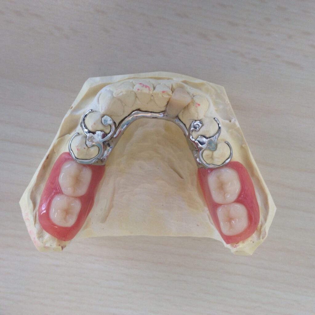 Modellguss – Blanchard Zahntechnik