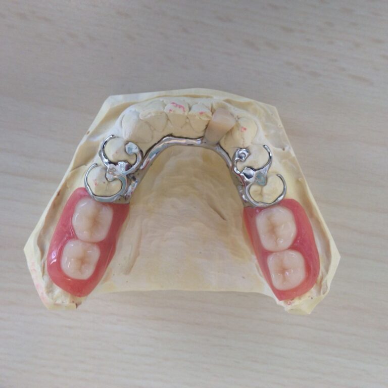 Modellguss - Blanchard Zahntechnik